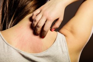 Textile Contact Dermatitis: Causes and Prevention - Dr. Bratt